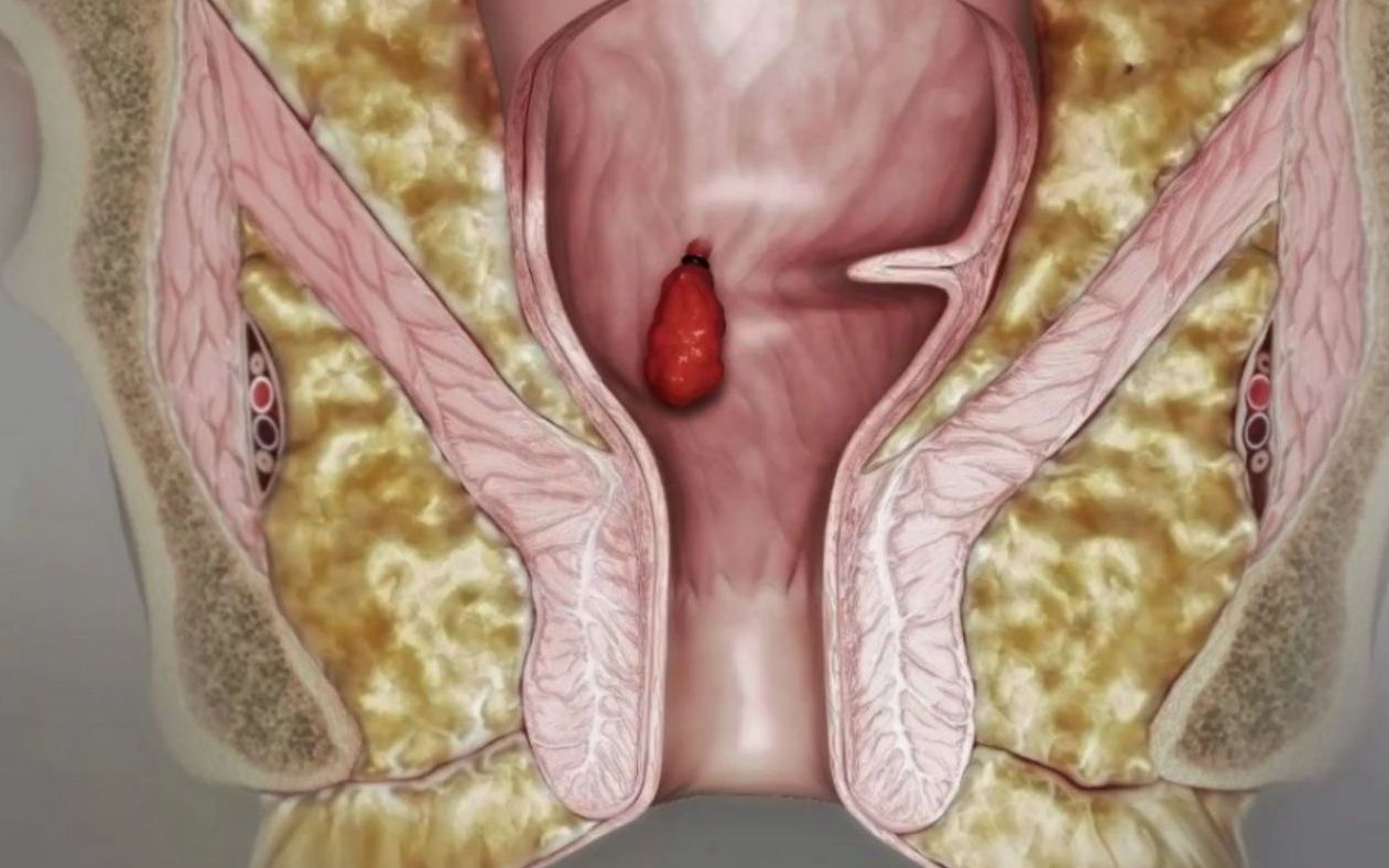 痔疮的症状和前兆你都了解清楚了吗?除了便血和肿痛,这个症状你也得...
