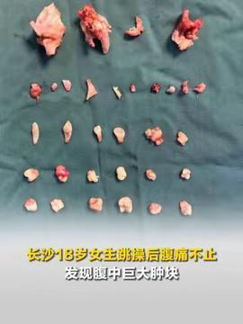...女生跳操后腹痛不止,发现腹中巨大肿块,里面竟是24颗形态各异的牙齿