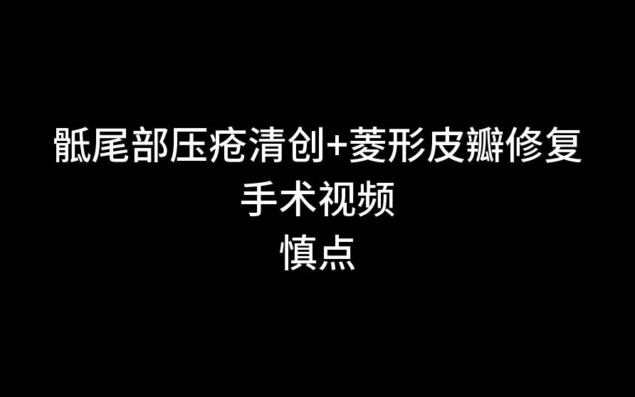 皮瓣手术之:骶尾部压疮,菱形皮瓣修复