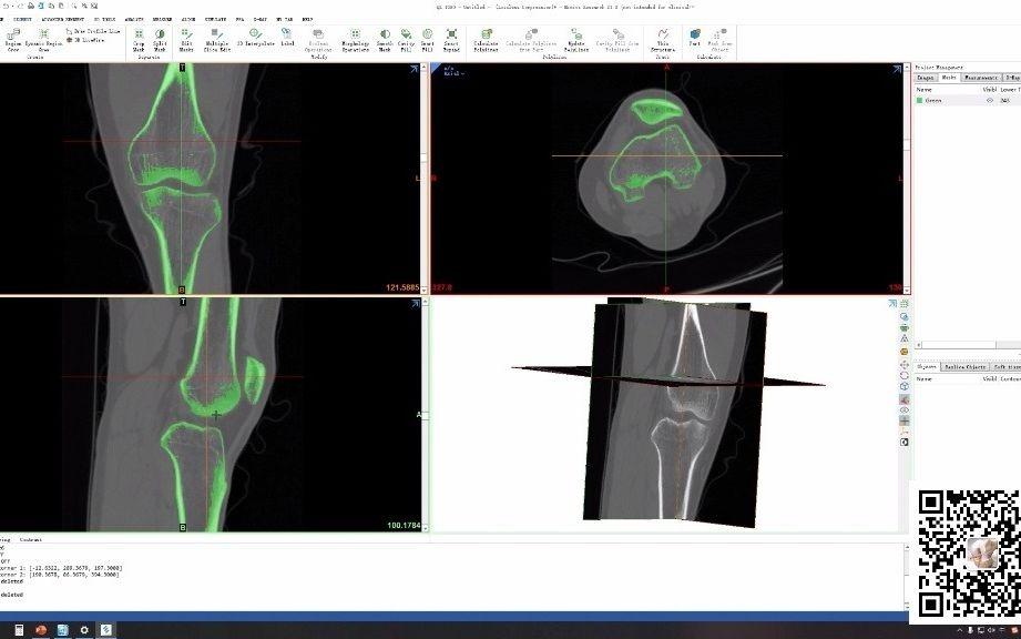 膝关节专题1-生物力学(如何使用mimics重建骨头模型?)