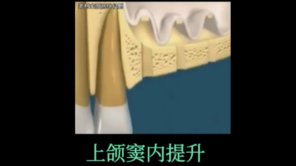 第51集:种牙没有哪么简单!当出现上颌骨高度不够时,就需要做上颌窦...