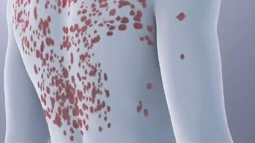 梅毒终身标记!感染后身体竟发生这些恐怖变化,速看保命!