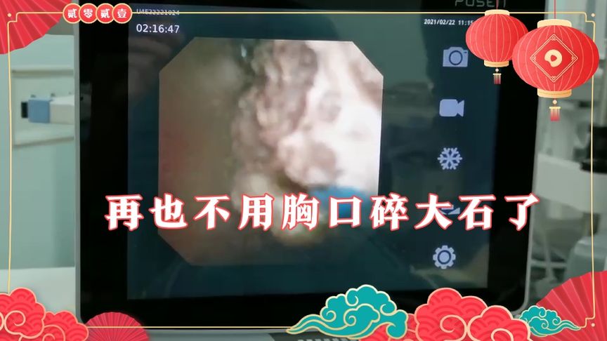 输尿管软镜精准打击肾盂内结石