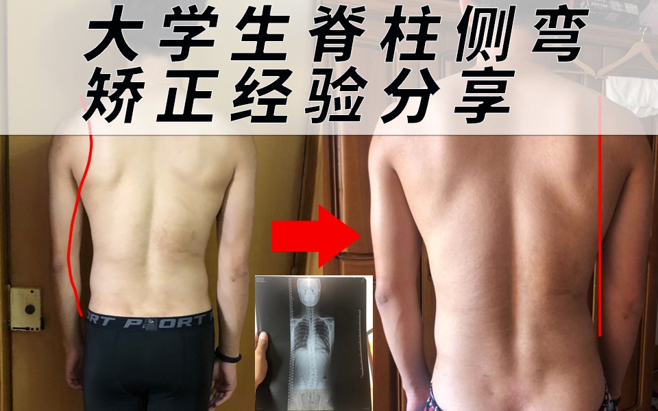 大学生脊柱侧弯矫经验分享&脊柱侧弯介绍
