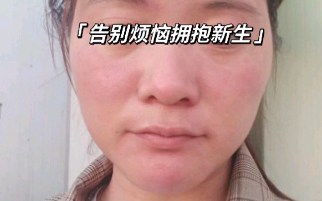 ...尽量不要使用护肤品、化妆品等外用产品,减少外用品对皮肤的刺激,...