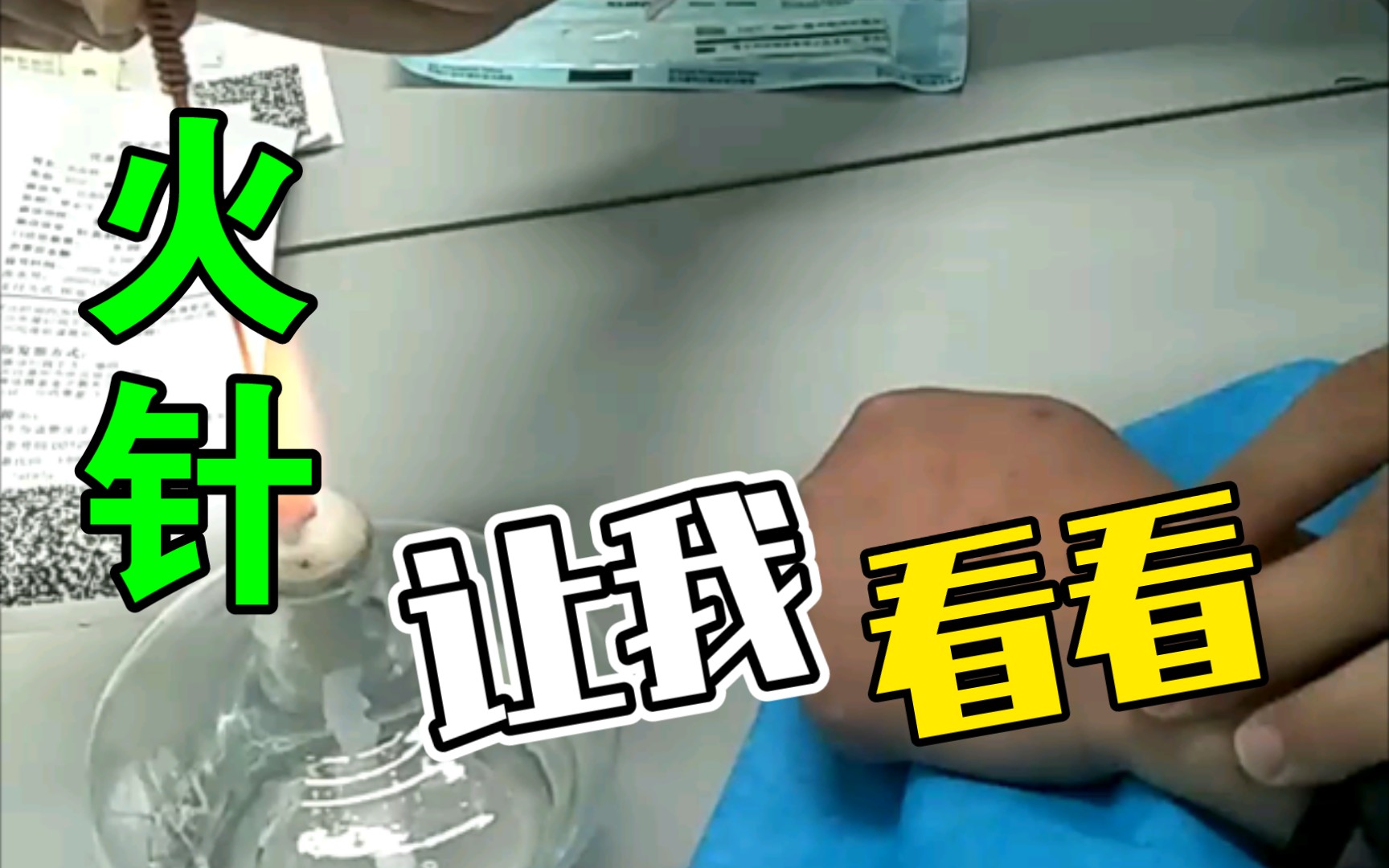 火针疗法展示|腱鞘囊肿|中医疗法