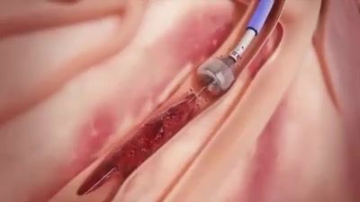 心肌梗死血栓抽吸示意动画