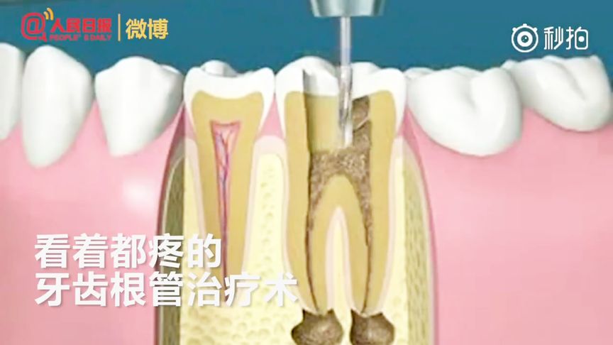 牙齿根管治疗的全过程你见过吗?