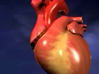 这是人体心脏冠状动脉粥样硬化的动画演示过程