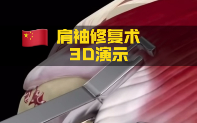肩袖撕裂缝合修复术3D动画演示过程