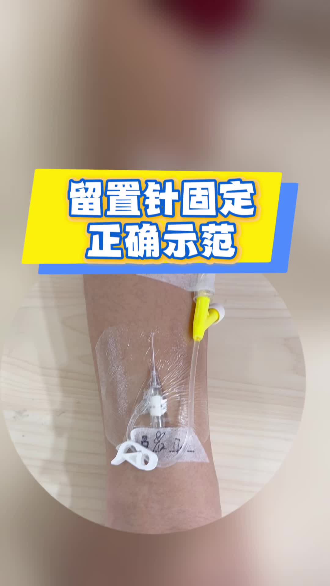 留置针固定正确示范 #留置针的正确固定 #留置针 #护士懂护士 #护理