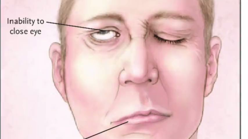 #面瘫#周围性面瘫#中枢性面瘫#面神经麻痹