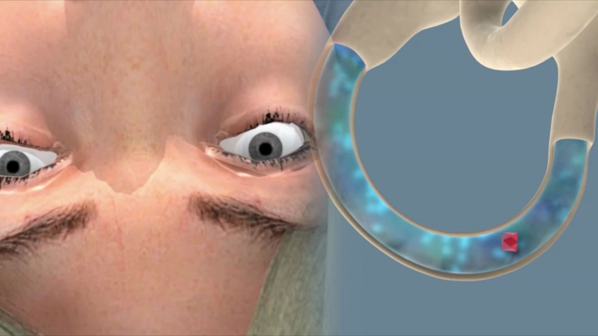 耳石在上半规管内的运动 良性位置性阵发性眩晕