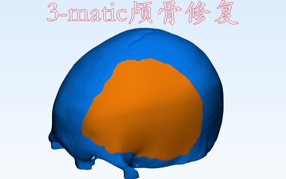Mimics、3-matic颅骨修复、假体设计标准教程2