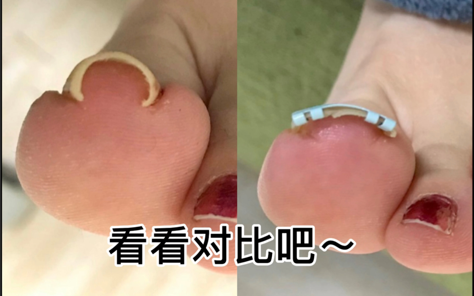甲沟炎#脚指甲往肉里长怎么办 #足部护理 #美甲#嵌甲 #小井卷指甲钳...