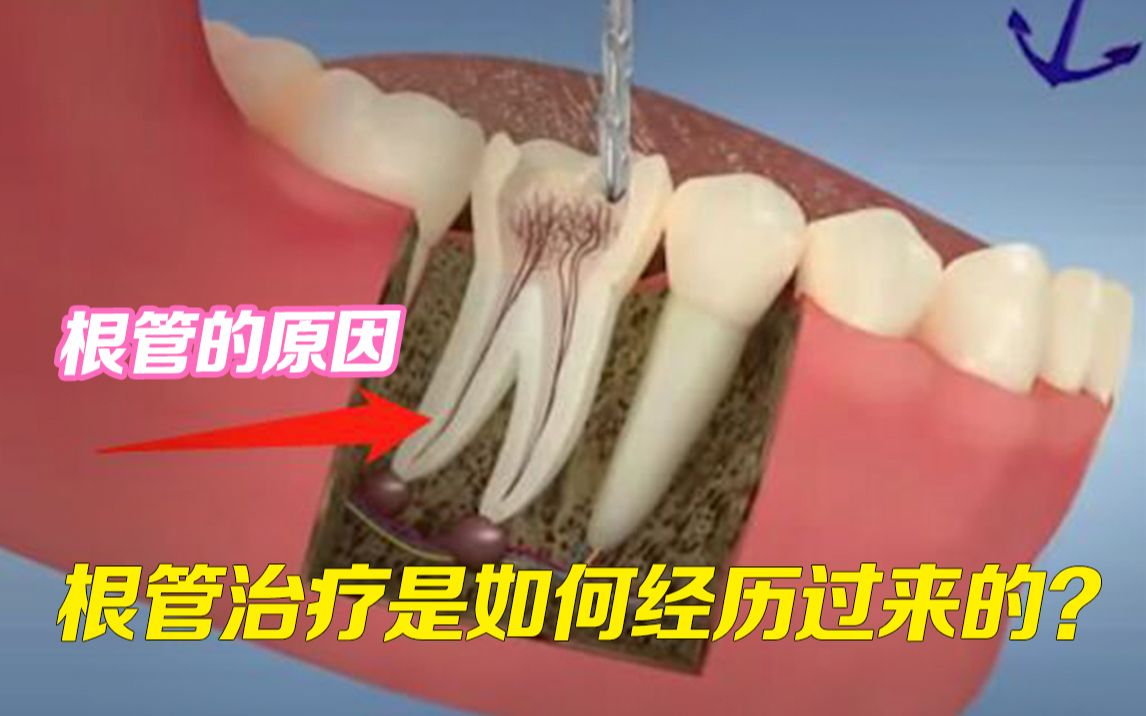 全剖析!根管治疗是怎么回事,为什么要做?
