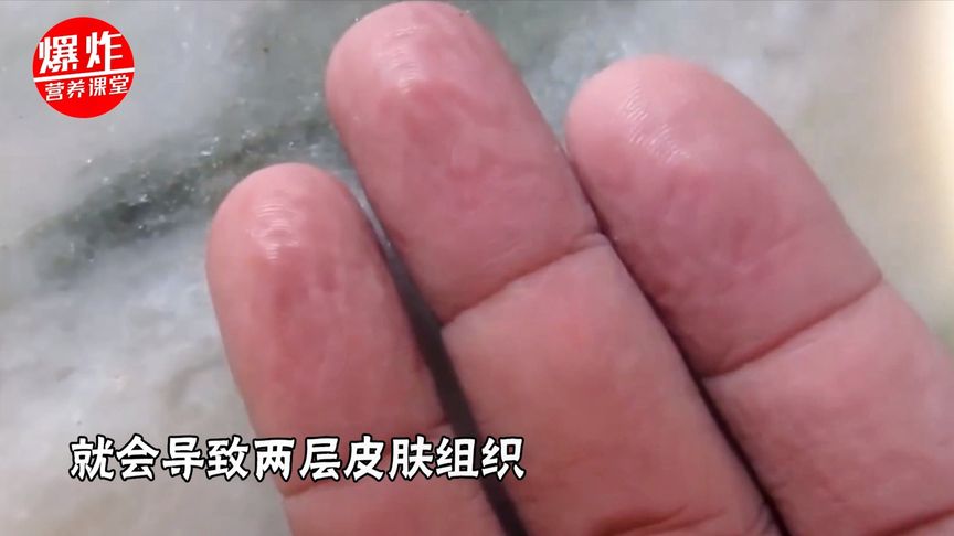 手指泡水后变得皱巴巴,缺少哪种维生素?别紧张,恰恰说明很健康