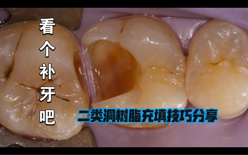 二类洞树脂充填技巧分享:流畅重塑边缘嵴。