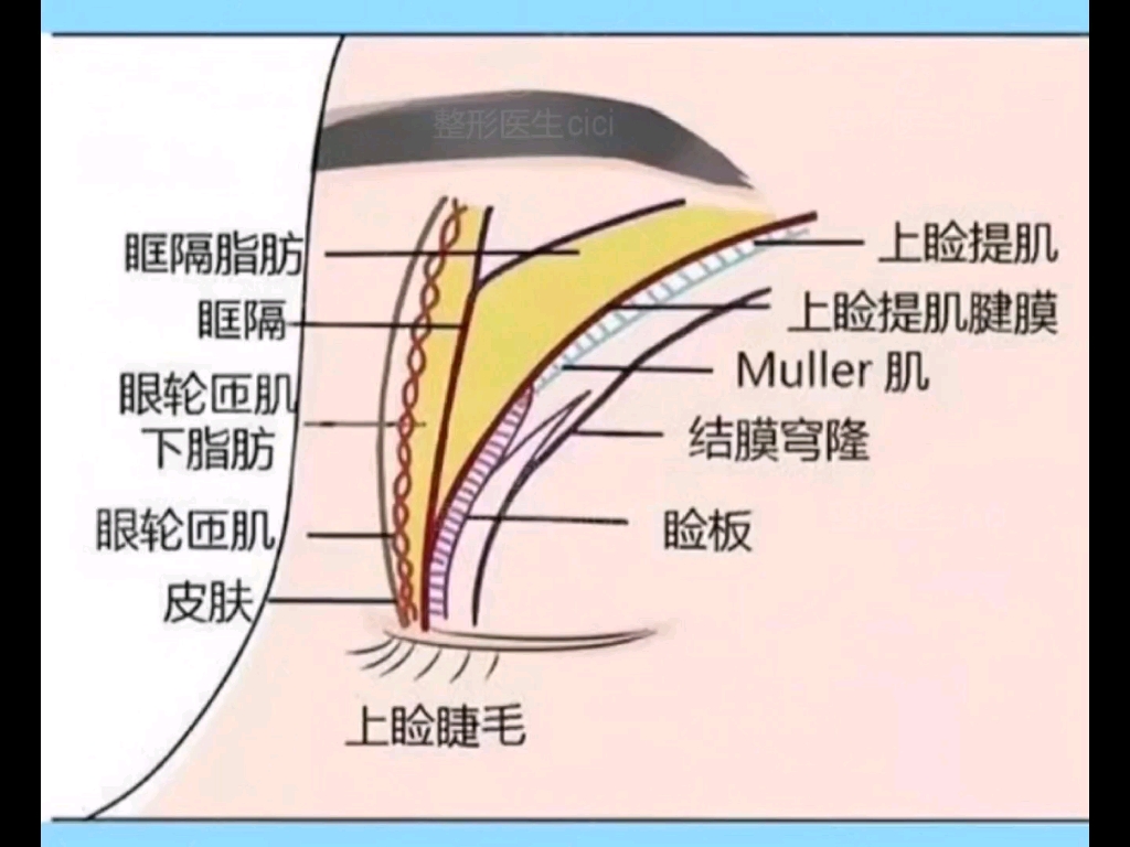 ...眼皮组织结构,我们的眼皮是由皮肤、眶隔脂肪、上睑提肌、睑板等组成