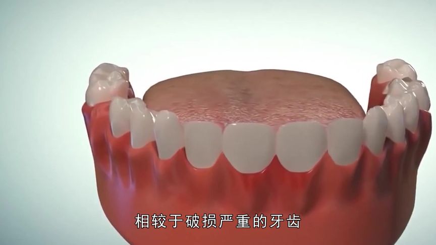 种植牙是怎么种的?3D动画演示全过程,答案跟你想的不一样!