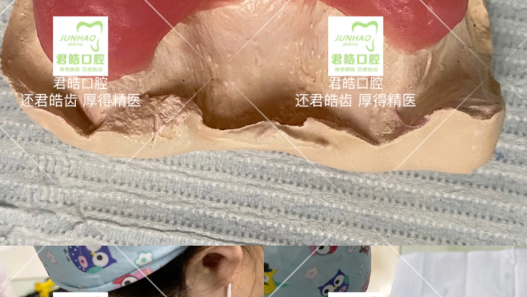 在刘老师的指导下第一次制作反颌矫治器[转圈][鼓掌]