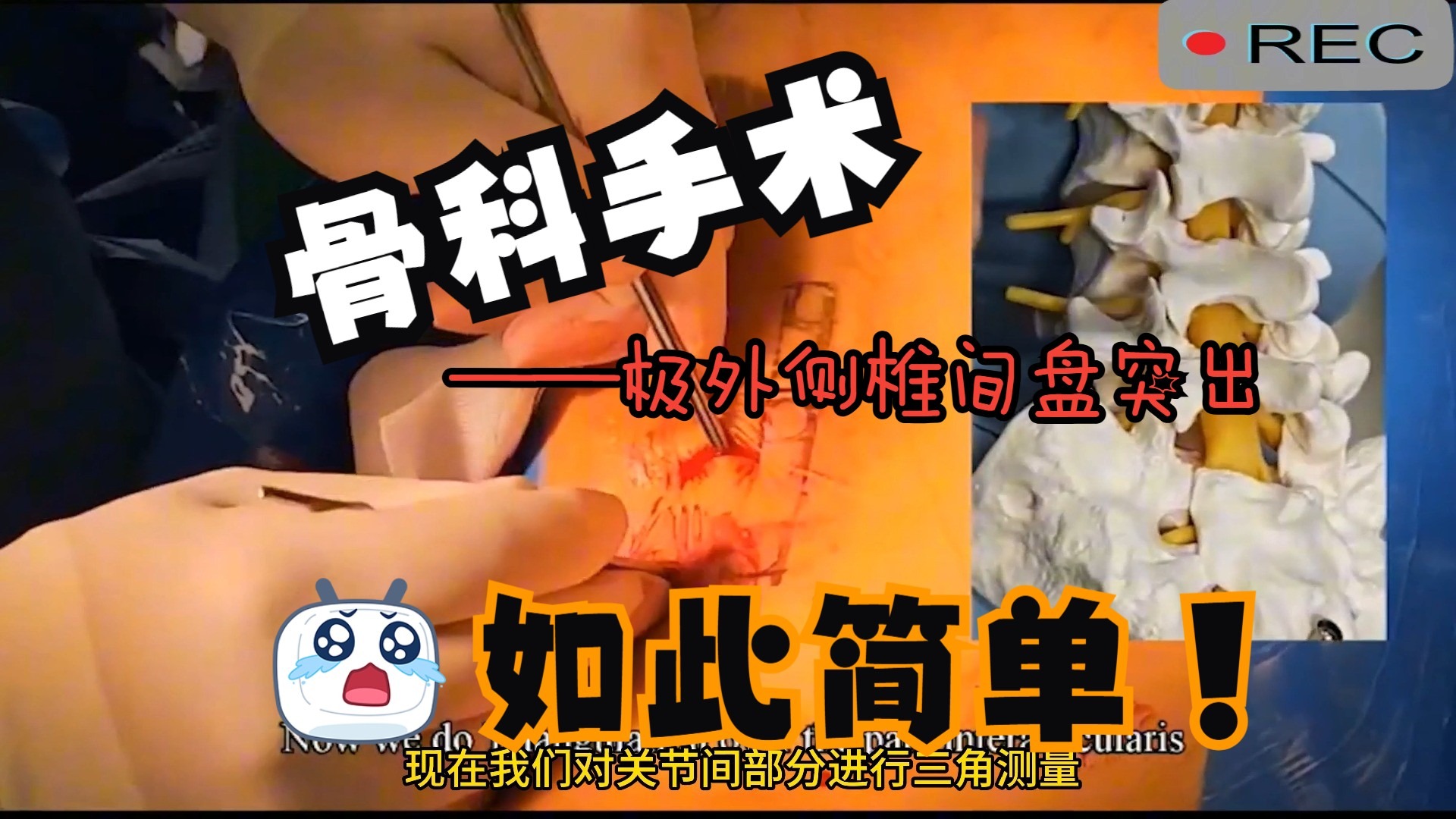 ...极外侧椎间盘突出怎么切?双通道新方法全流程实录 | UBE术式的延申...