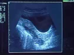 FC038 异位妊娠