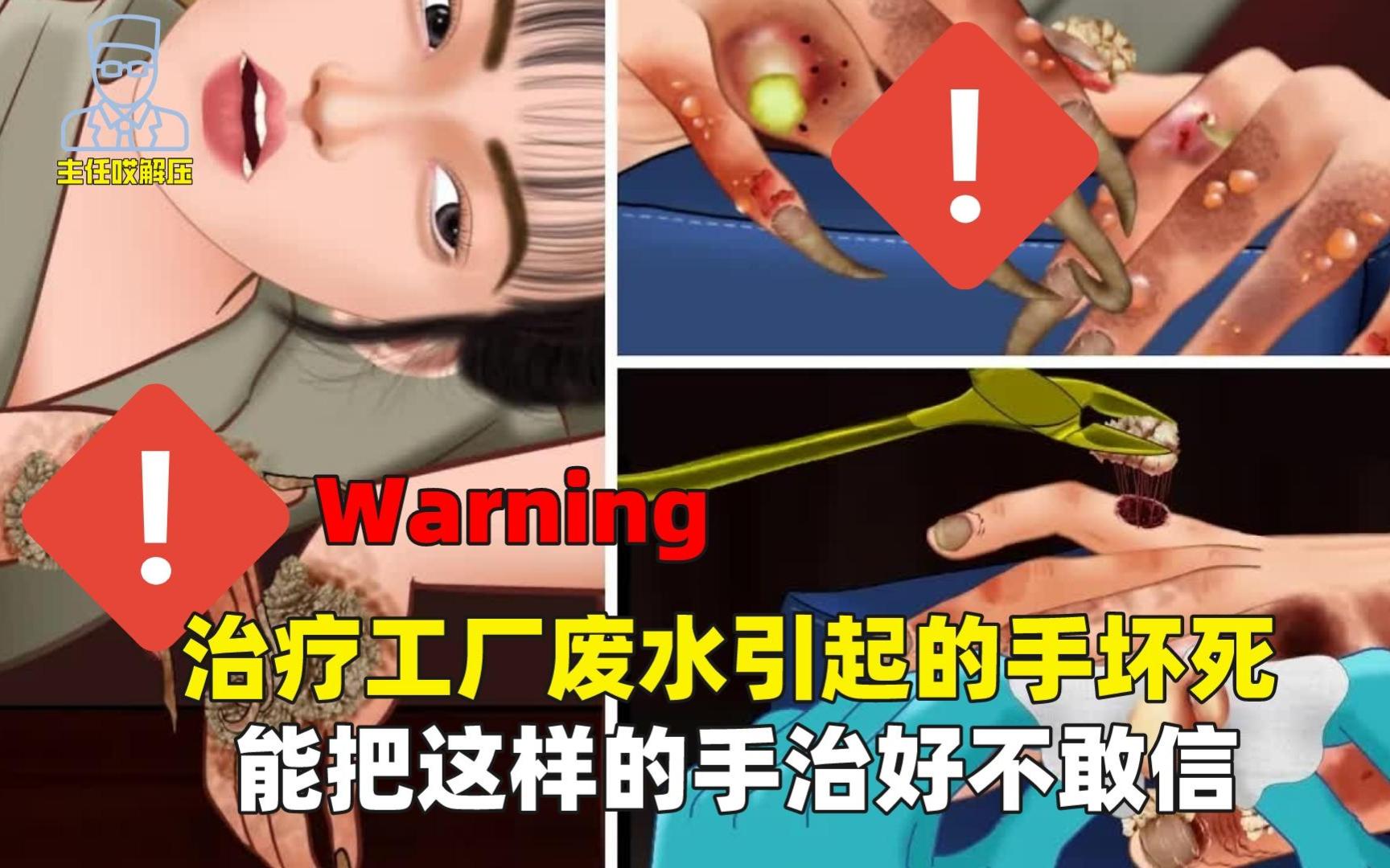 解压动画,治疗工厂废水引起的手坏S,能把这样的手治好不敢相信!