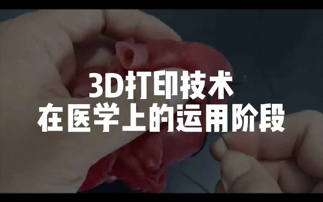 3D打印在医学领域上的四个阶段运用