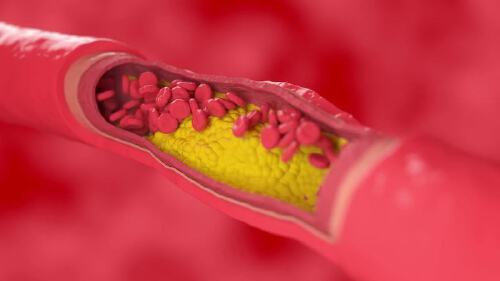 血管一年比一年堵?5招疏通血管,现在知道还不晚!