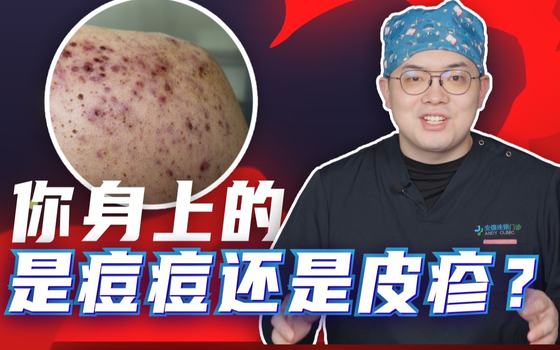 【皮肤科】身上的痘痘和皮疹该如何区分和治疗?看完视频你就知道了!