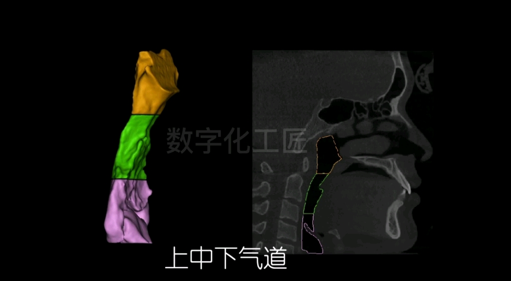 mimics CBCT 三维重建气道,上中下分段显示