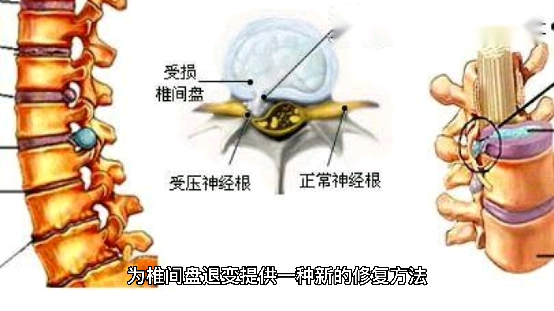 干细胞将成为修复椎间盘退变的新替代疗法。