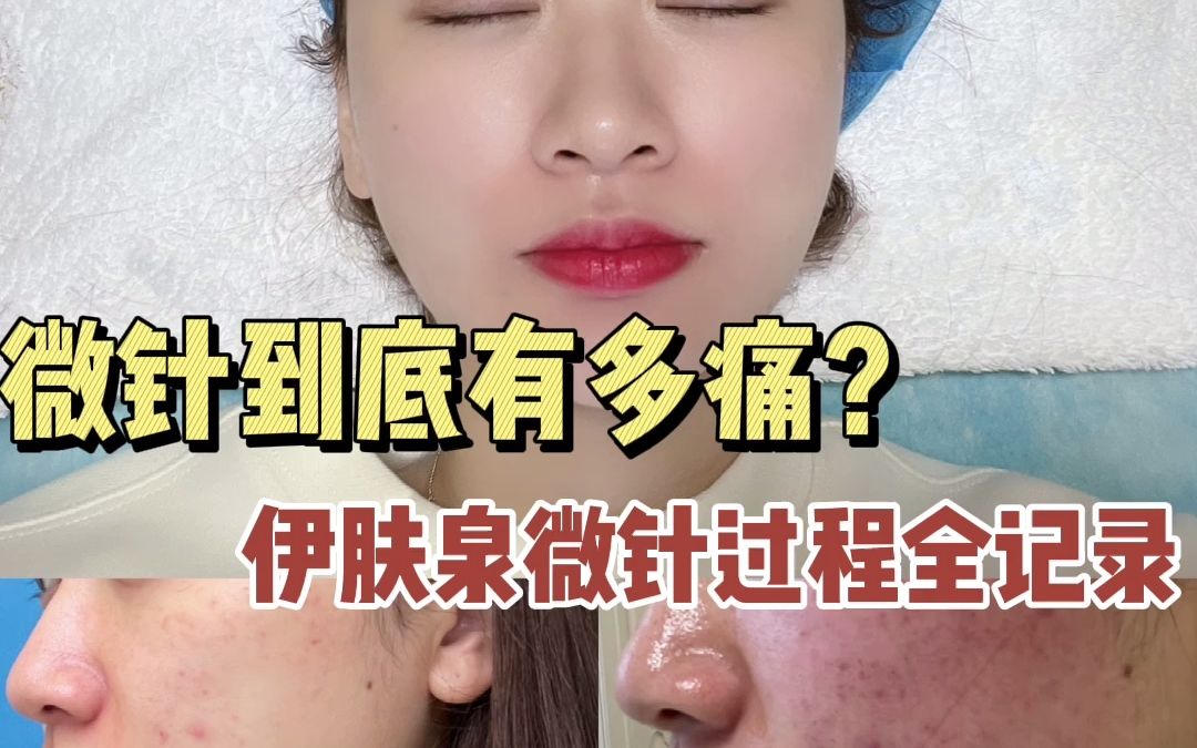 微针到底有多痛?