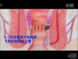 自动痔疮套扎器