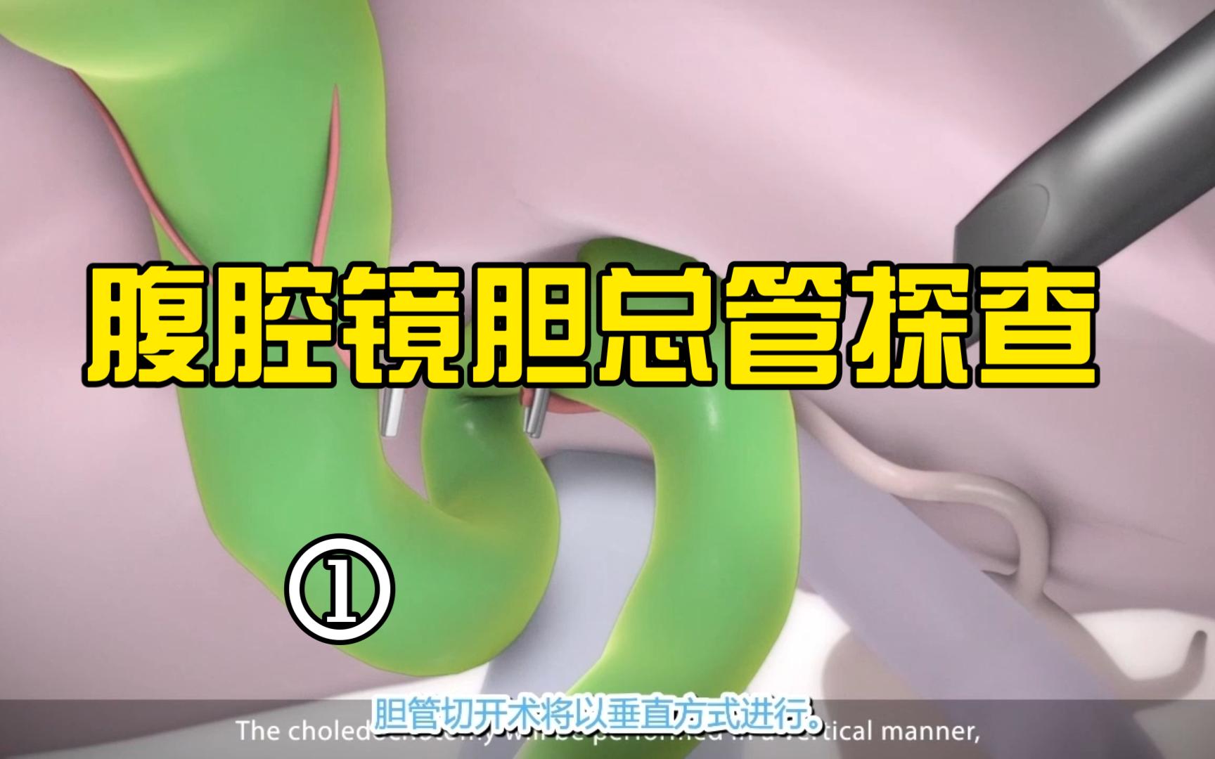 腹腔镜胆总管探查