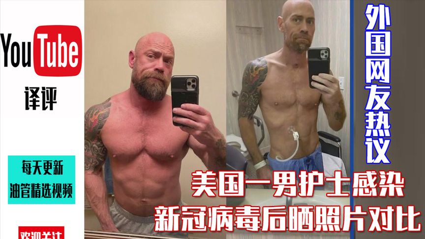 美国一男护士感染新冠病毒后晒照片对比,外国网友热议