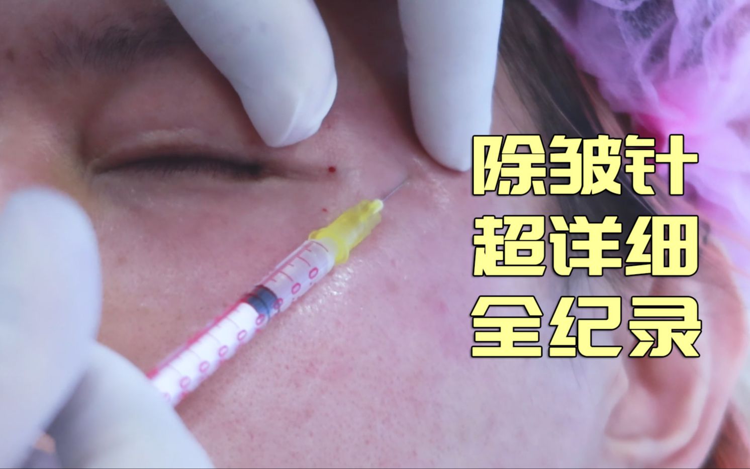 【木木】除皱针超详细全过程|打完皱纹立刻消失?