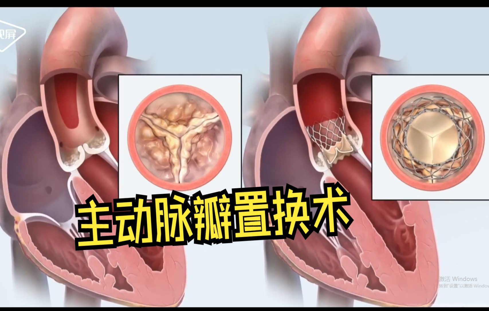 【医学3D】经导管主动脉瓣置换术 (TAVR) —主动脉瓣狭窄的治疗方法