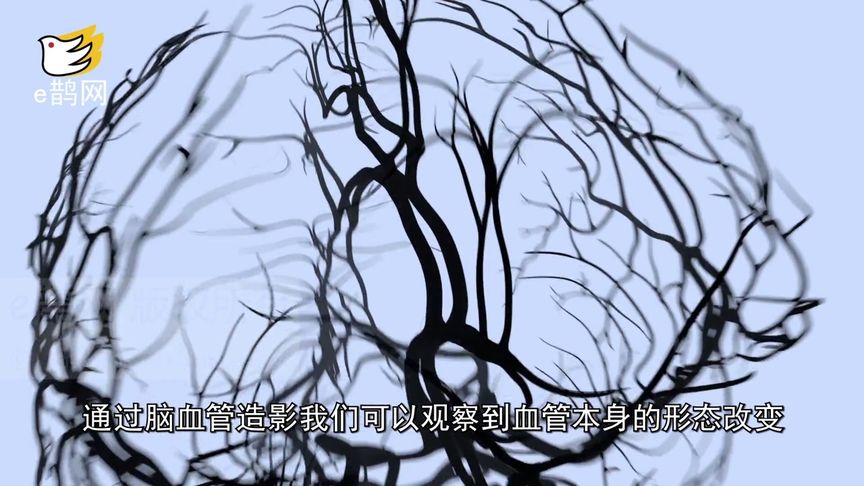 一个视频让你了解神奇的“脑血管造影术”!