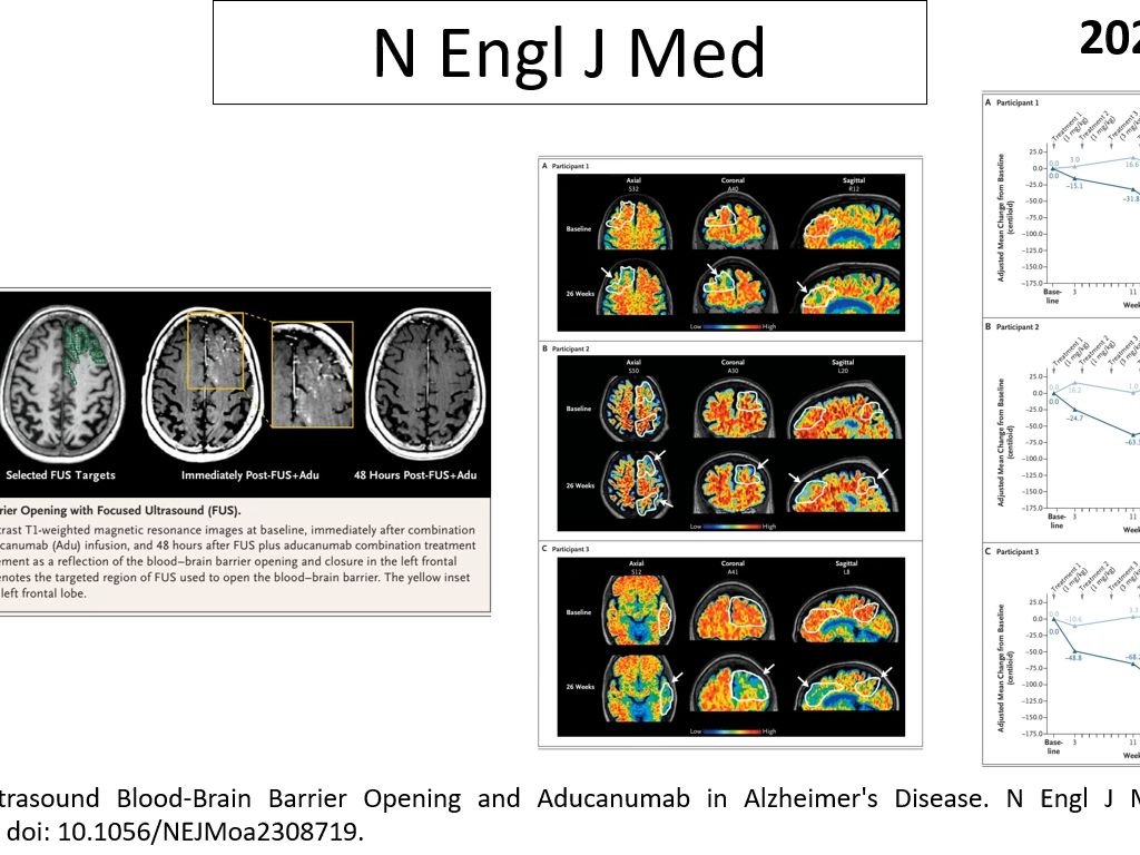 N Engl J Med—AD研究重磅:聚焦超声联合抗Aβ单抗输注对Aβ的清除...