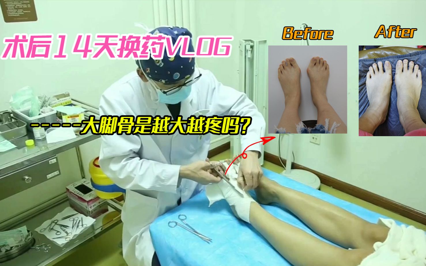【苏敬达】拇外翻微创手术后14天换药记录,大脚骨真的越大越疼