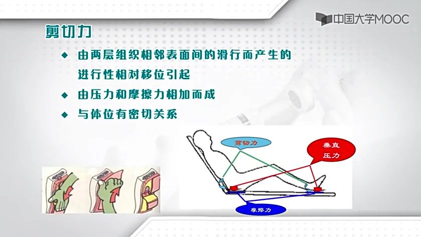 第四周 清洁卫生护理、休息与活动:患者压疮发生原因与风险评估1