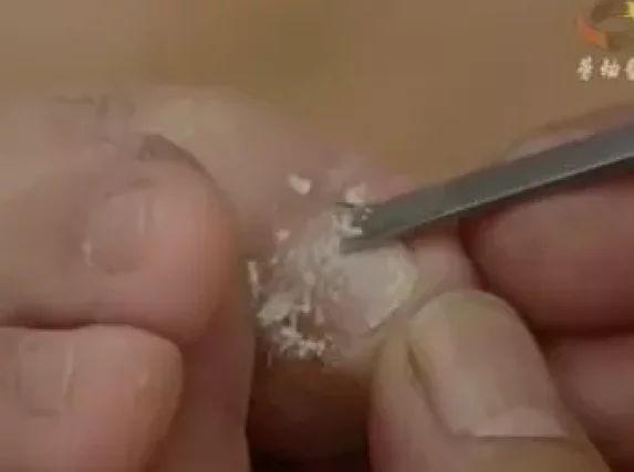 家庭足疗修脚教程——中级