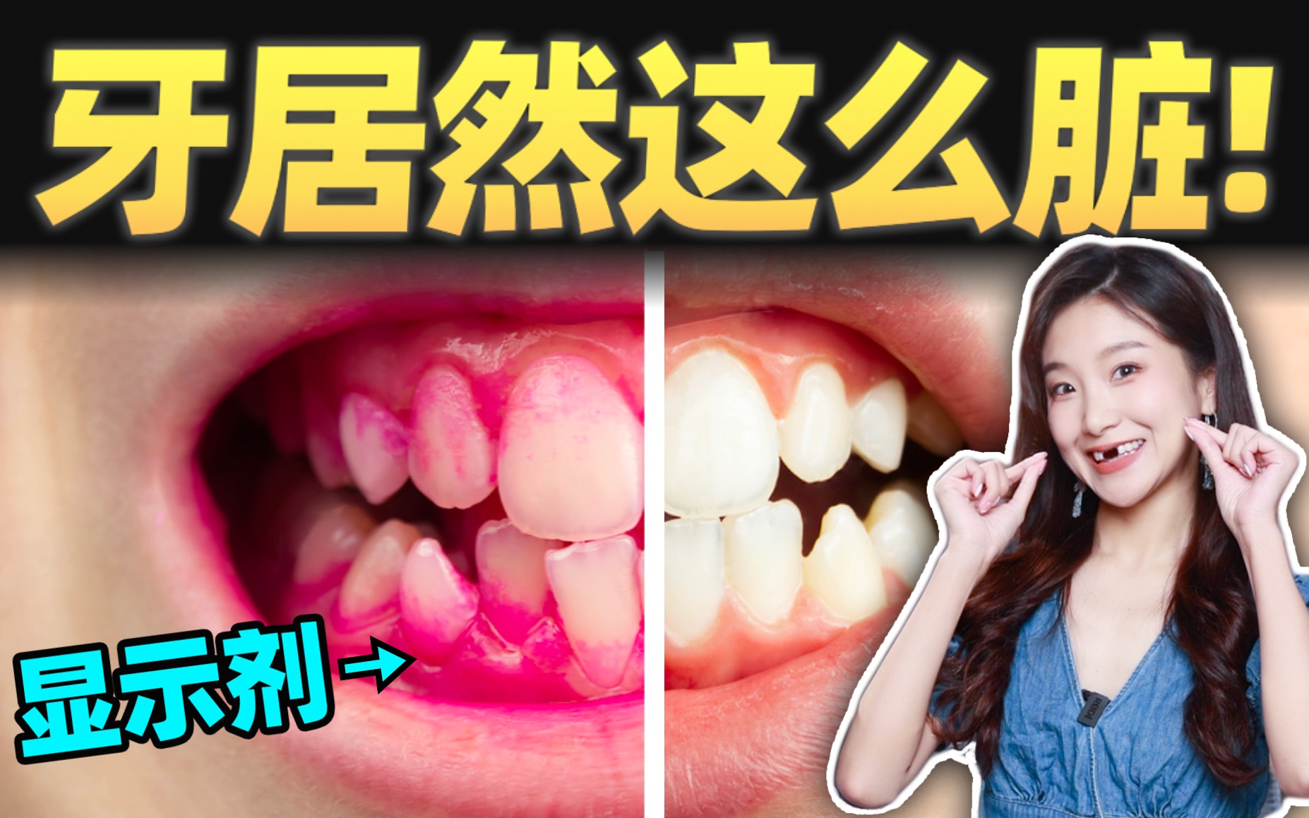 2000亿细菌在你牙上恰饭?睡前不刷牙,堪比满汉全席