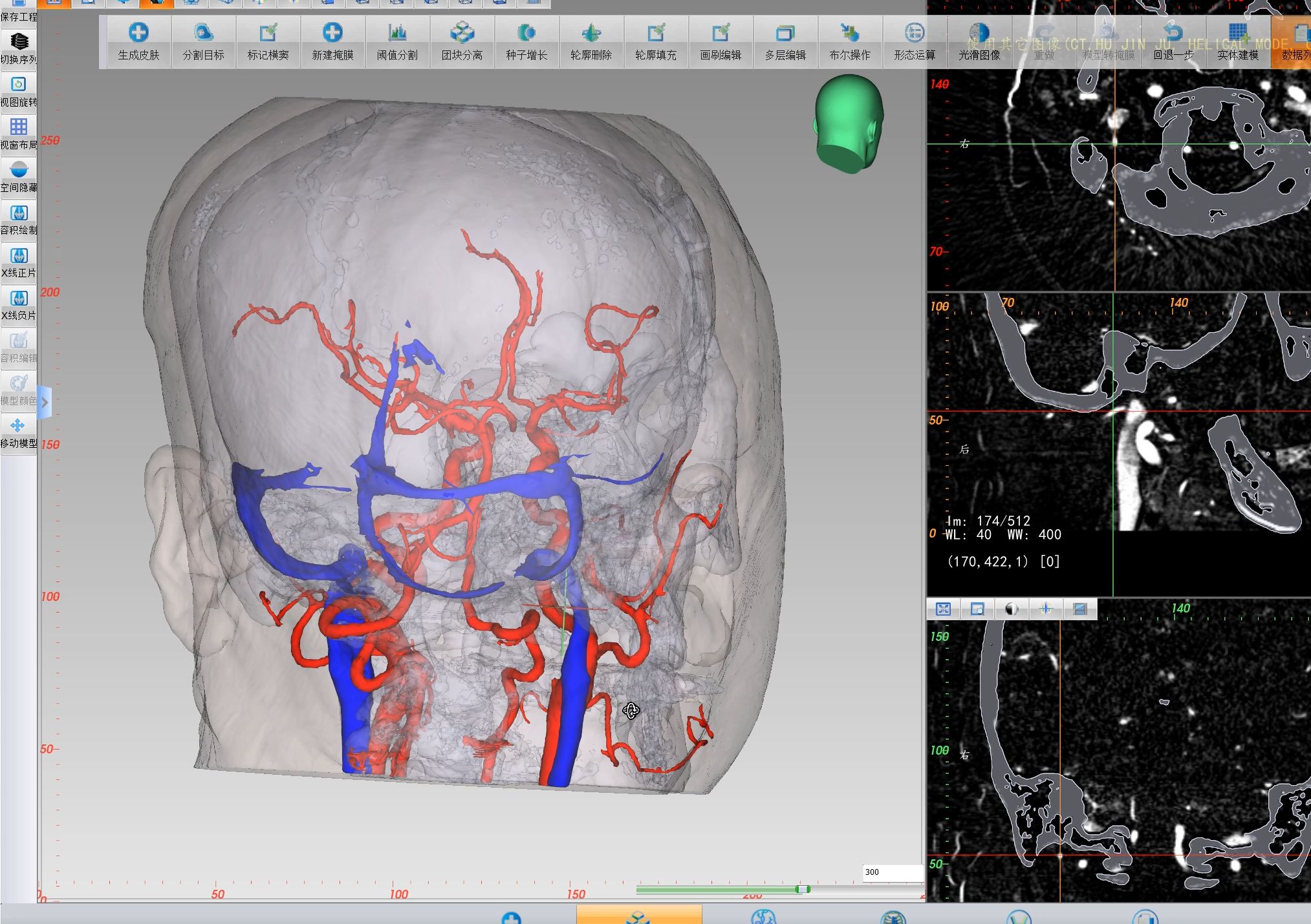 3D eMIPs 动脉,静脉血管建模教程