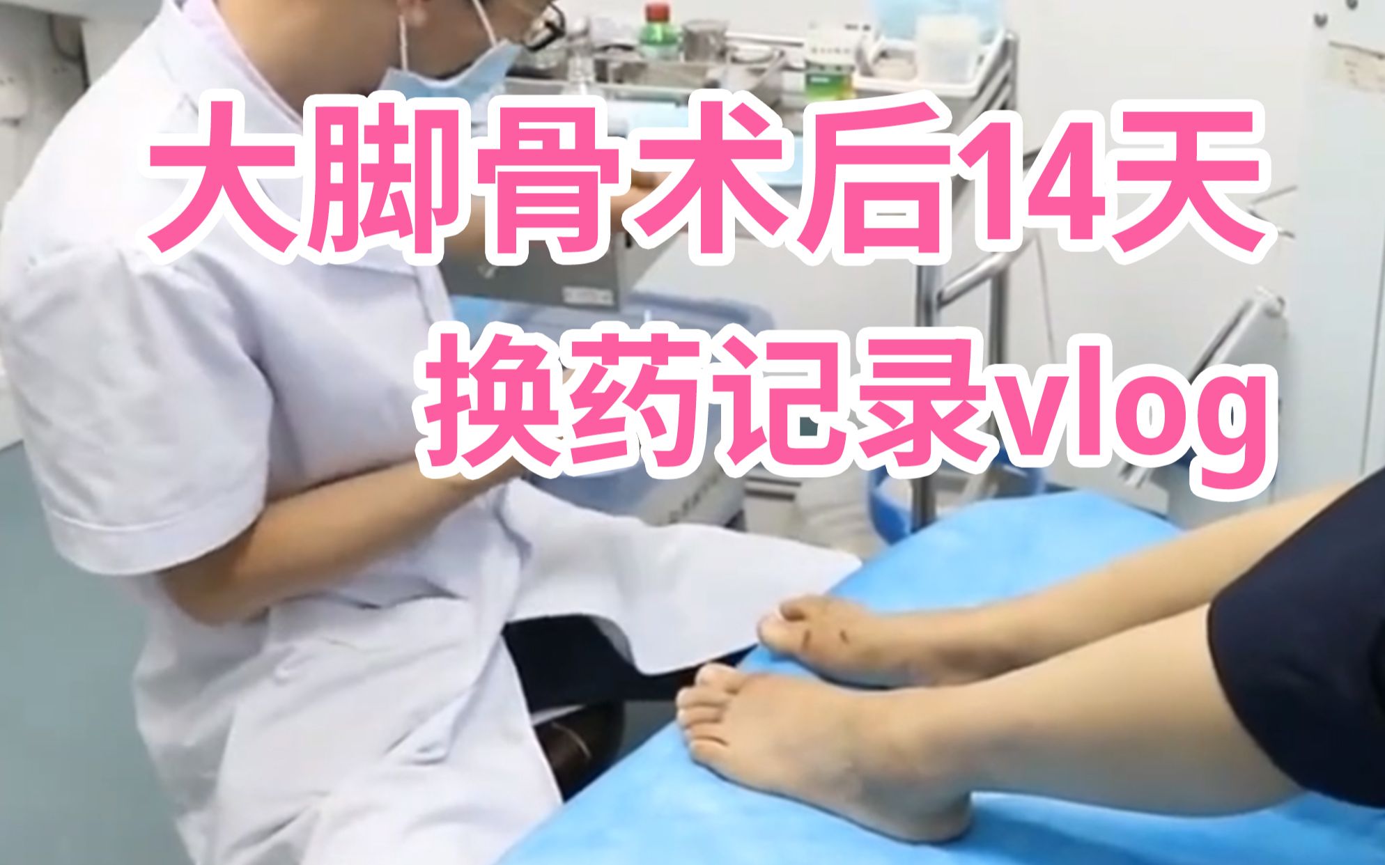 北京苏敬达医生:大脚骨拇指外翻术后拆线了,没有想象中疼,放心了