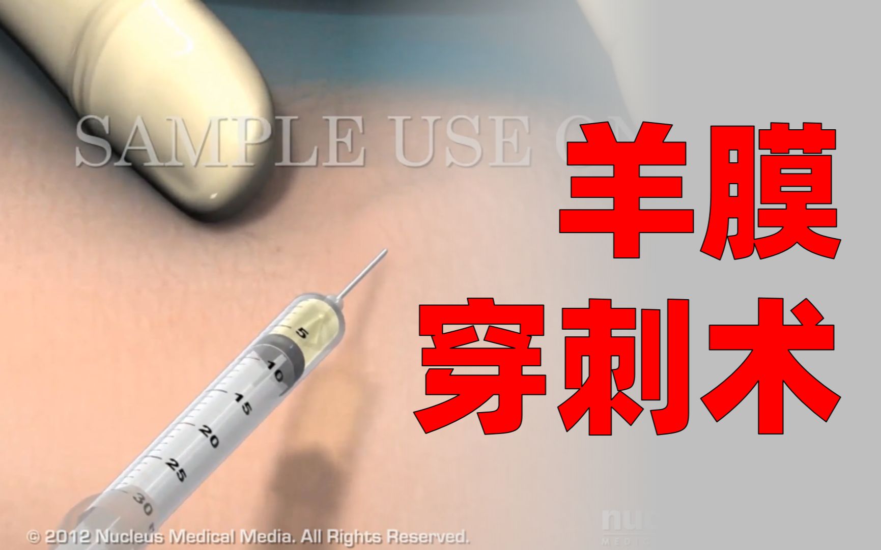 【3D医学动画】羊膜穿刺通常用来排查胎儿是否患有遗传疾病(中英双...