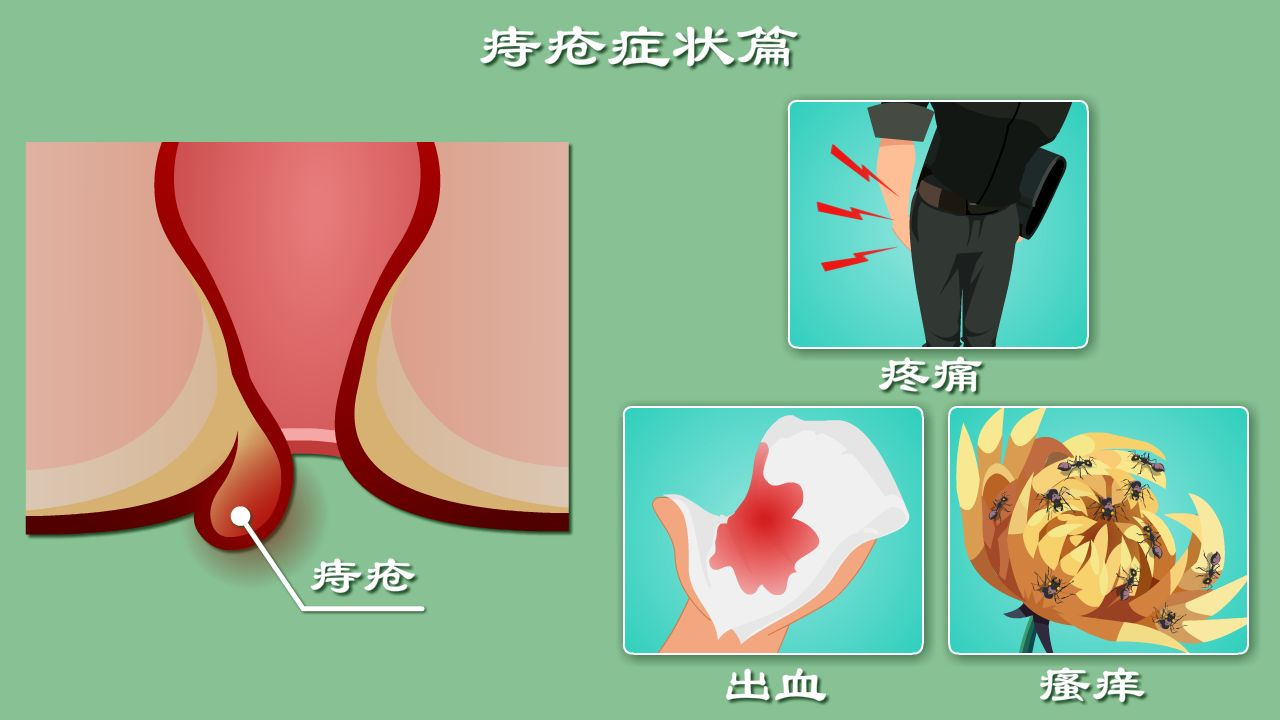 痔疮1:原来你是这样的痔疮