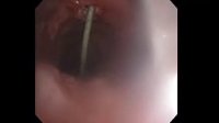 蓝犀牛经皮切开套装【口腔内视角】